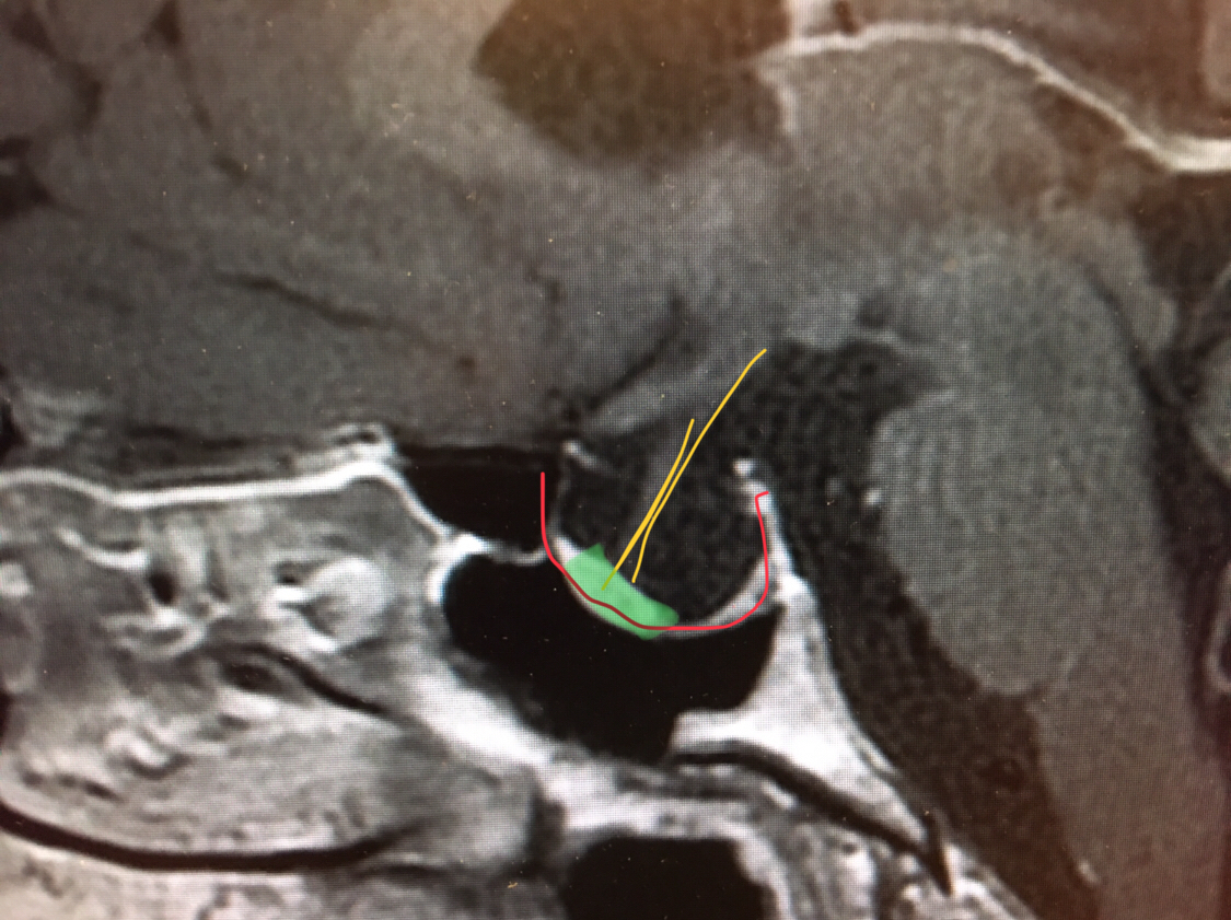 Dr. Blevins reviews an empty sella case - Pituitary World News