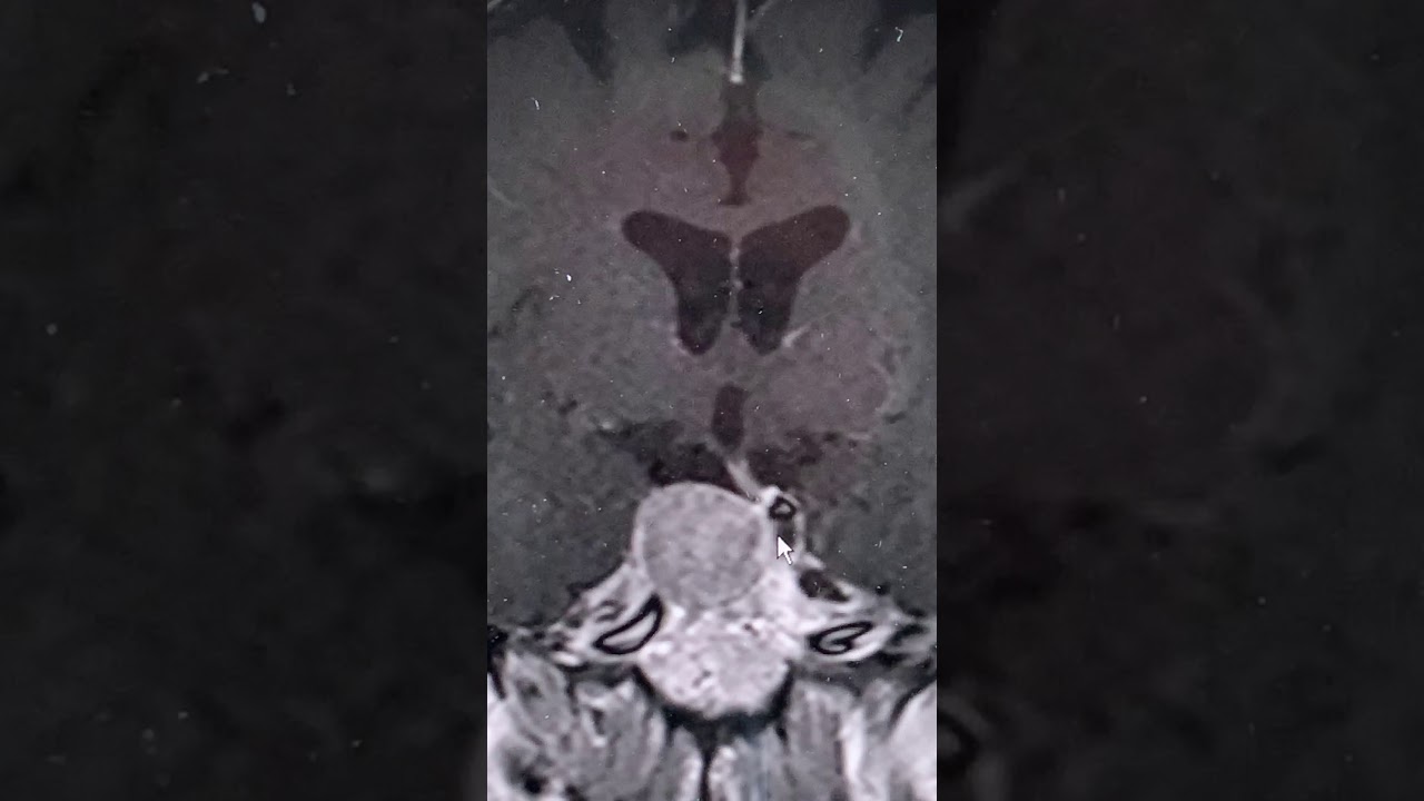 Pituitary Mri Educational Series A Partially Resected Pituitary Macro