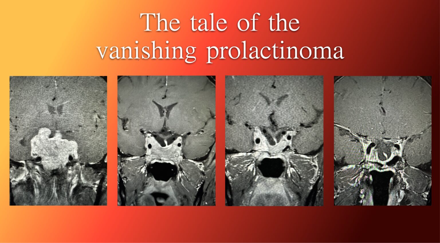 Prolactinoma Archives - Pituitary World News